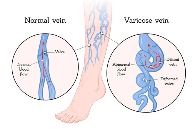 Varicose veins and Superficial venous Disease - Treatment with Varithena