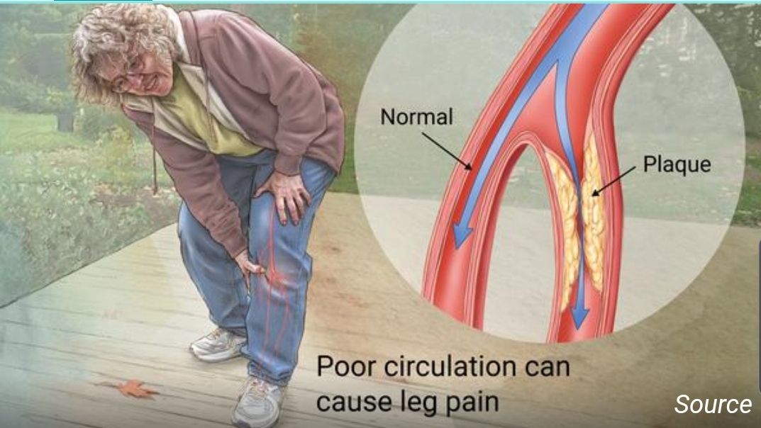 Lower Limb Ischemia - Vascular Claudication