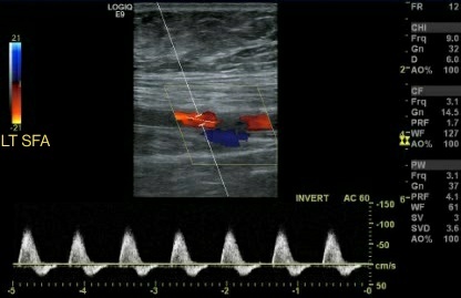 BILATERAL LOWER EXTREMITY Arterial Duplex Criteria.