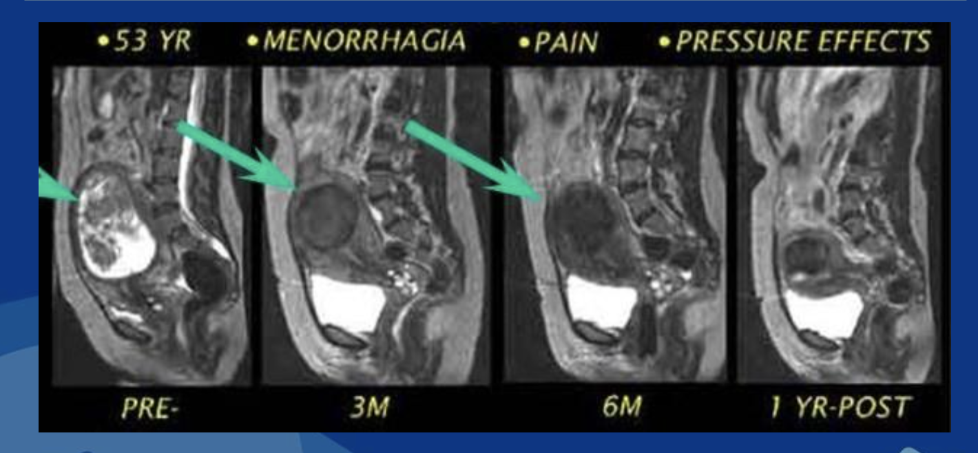 Uterine Fibroid shrinking over time after UFE - Graphic with MRI images