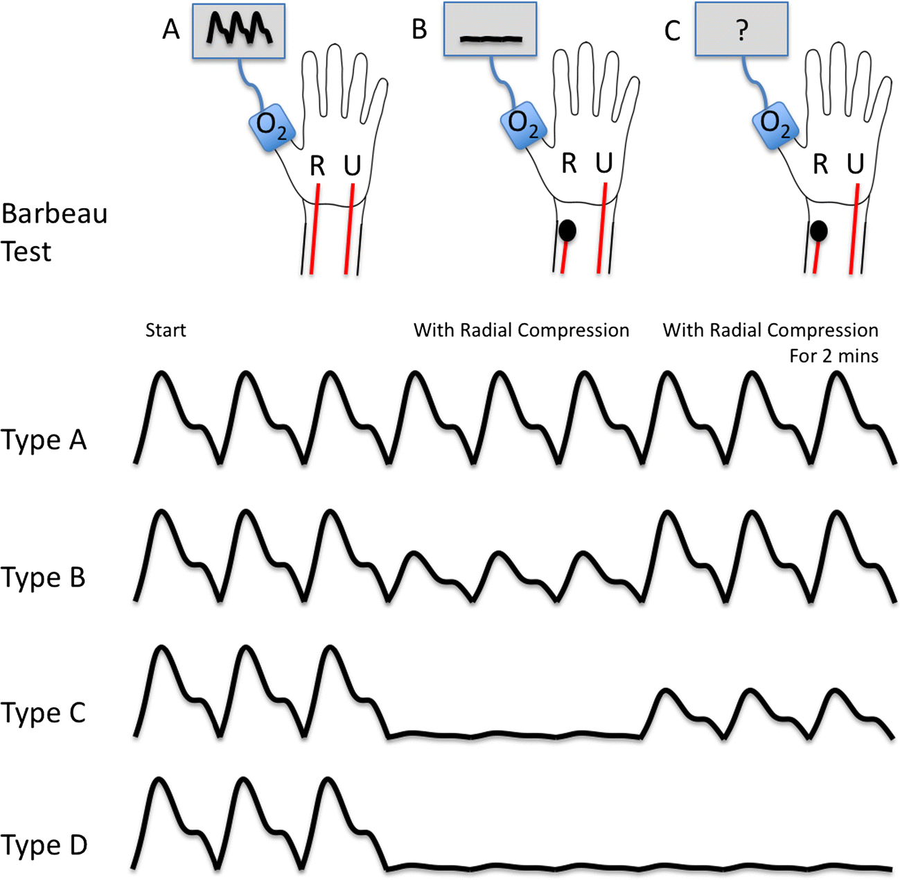 Barbeau test- Basics Knowledgebase - UFE Uterine Fibroids