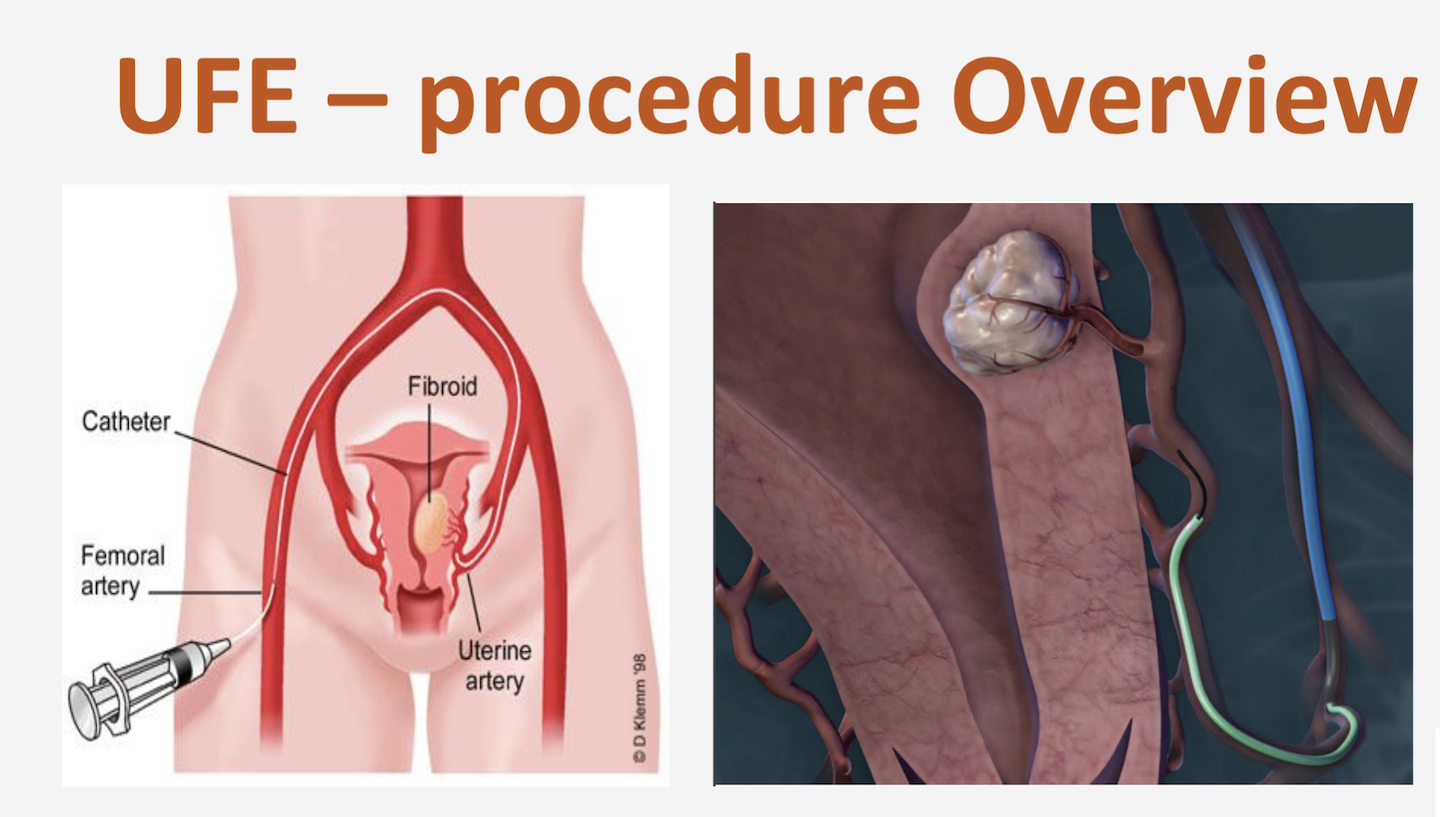 Basics about uterine fibroids and the (UFE) Uterine Fibroid Embolization procedure