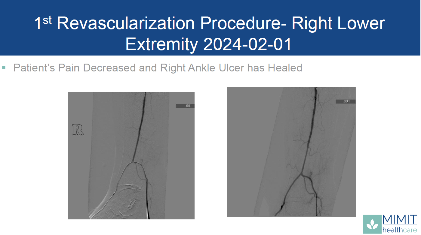 Case Study of a 90-Year-Old Female with Critical Limb Ischemia and ...